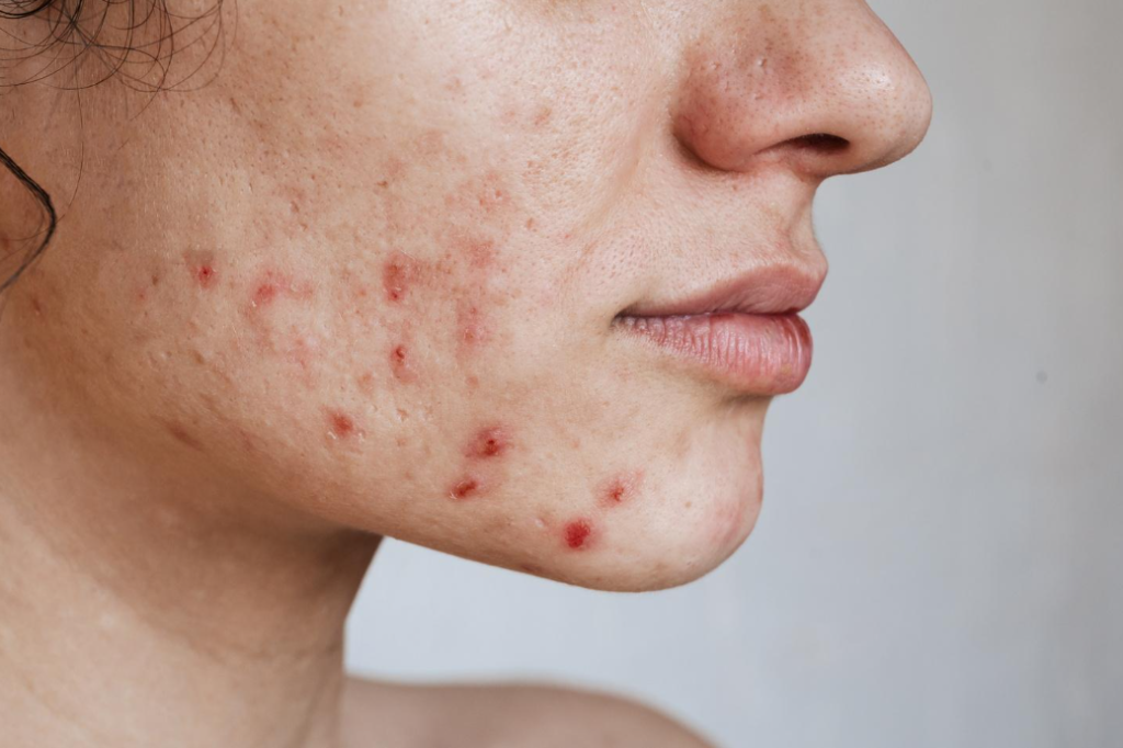 Breakouts 101 – Why They Happen and How to Prevent and Treat Them for ...