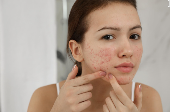 Acne Scars and Pigment – Why They Often Appear Together and How to ...